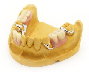 Prothesen – implantatgetragene, Klammer-, Teleskop- oder Geschiebe ...